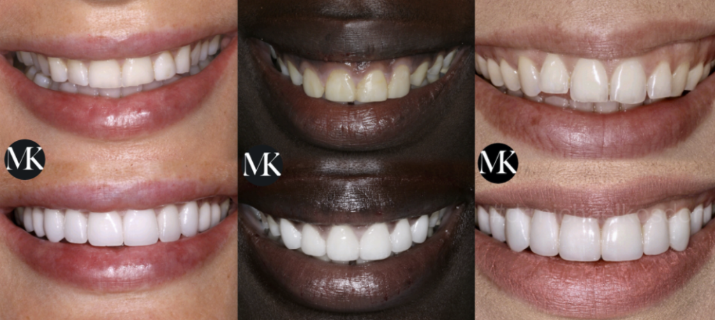 Is it Possible to Fix My Asymmetrical Smile?