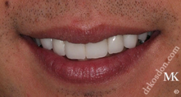 Is There a Solution for Excess Gum Tissue?