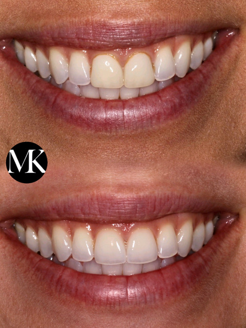 I Need Two Front Teeth